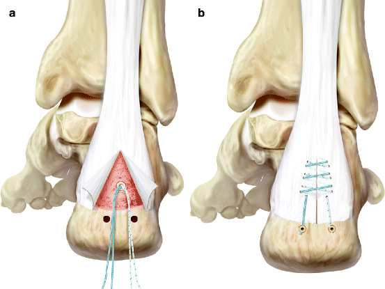 Insertional and Midsubstance Achilles Tendinopathy | SpringerLink