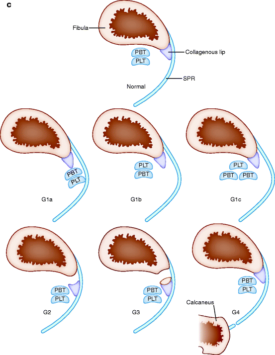 Peroneal Tendinopathy | SpringerLink