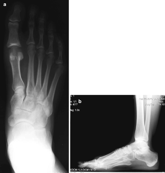 Hallux Rigidus: The Valenti Arthroplasty | SpringerLink