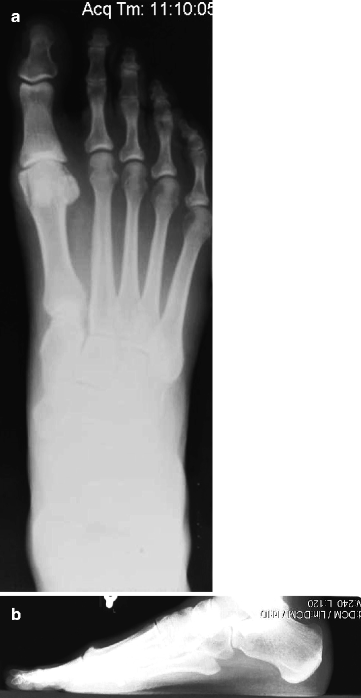 Hallux Rigidus: The Valenti Arthroplasty | SpringerLink