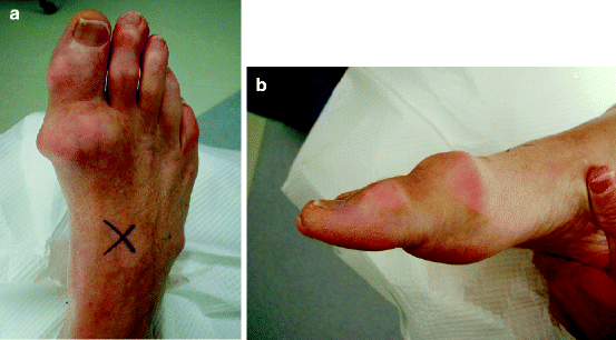 Arthrodesis of the First Metatarsophalangeal Joint | SpringerLink