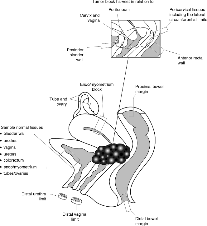 Pelvic Exenteration Specimens | SpringerLink