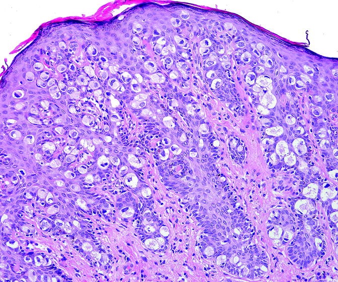 Skin Adnexal Tumors | SpringerLink