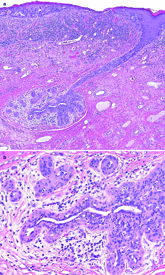 Skin Adnexal Tumors | SpringerLink