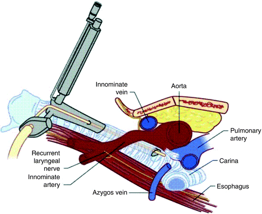 Anesthesia for Patients with Mediastinal Masses | SpringerLink
