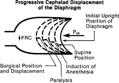 Physiology of the Lateral Decubitus Position, Open Chest and One-Lung ...