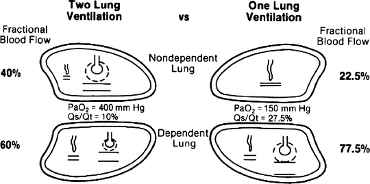 Physiology of the Lateral Decubitus Position, Open Chest and One-Lung ...