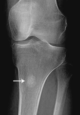 How to Evaluate a Bone Lesion | SpringerLink