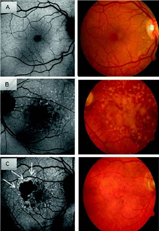 Fundus Autofluorescence Imaging in Age-Related Macular Degeneration and ...