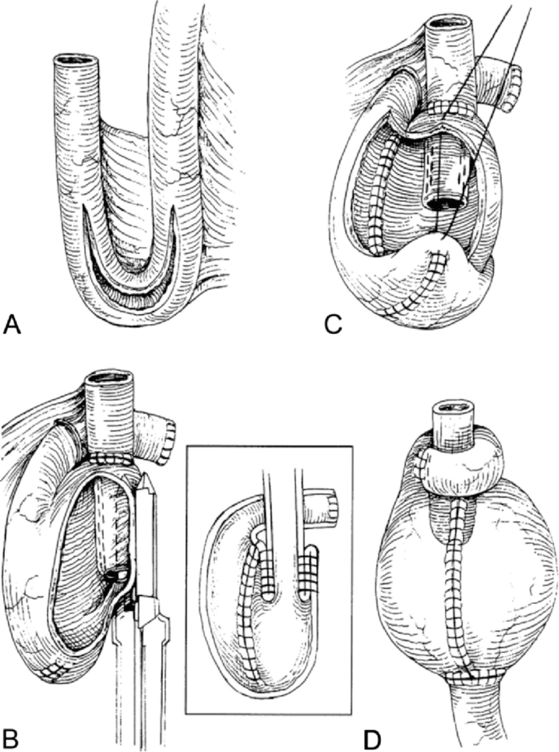 Ulcerative Colitis: Surgical Management | SpringerLink