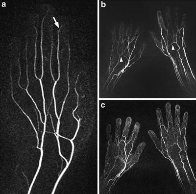MRA: Upper Extremity and Hand Vessels | SpringerLink
