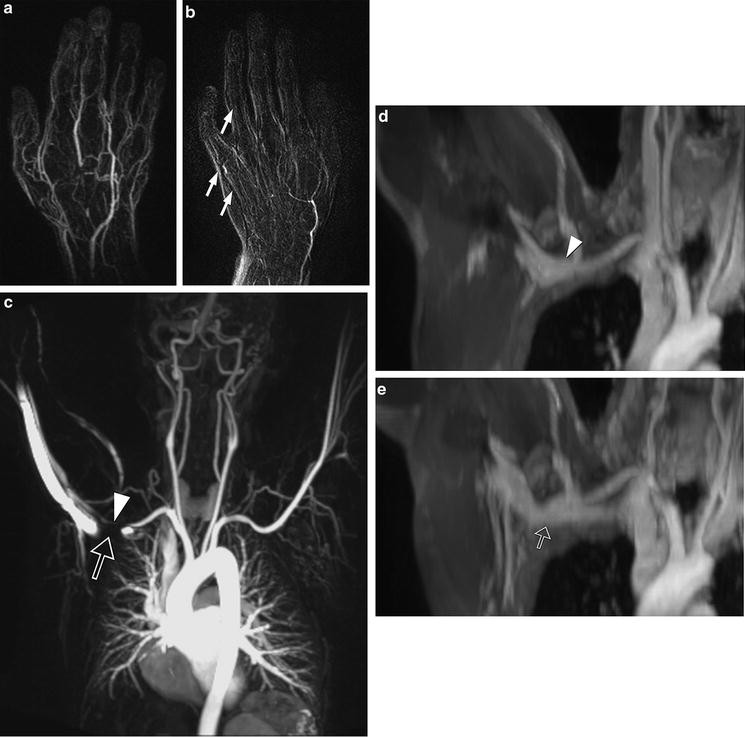 MRA: Upper Extremity and Hand Vessels | SpringerLink
