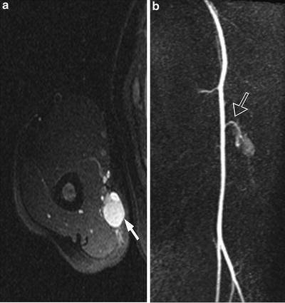 MRA: Upper Extremity and Hand Vessels | SpringerLink