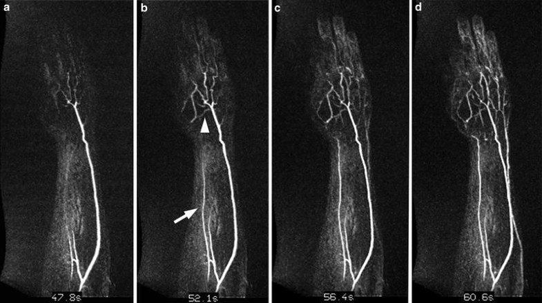 MRA: Upper Extremity and Hand Vessels | SpringerLink