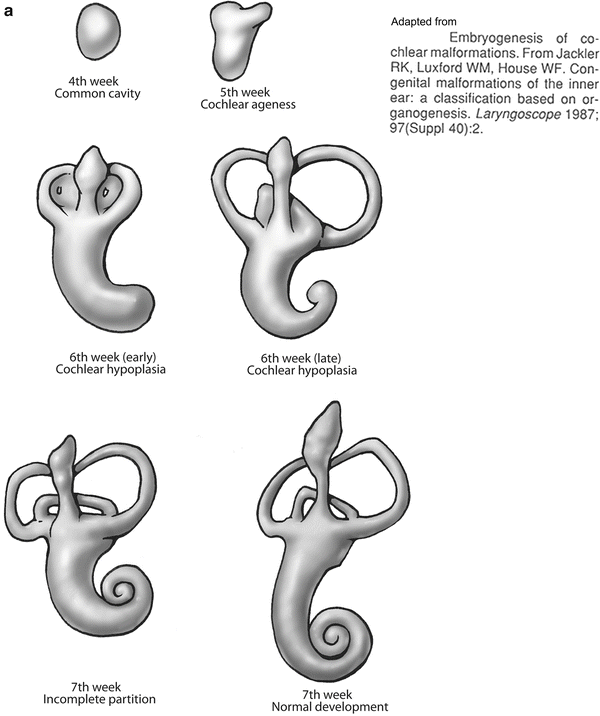 Congenital Malformations of the Ear | SpringerLink