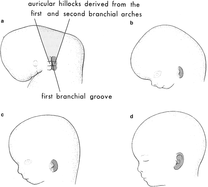 Congenital Malformations of the Ear | SpringerLink