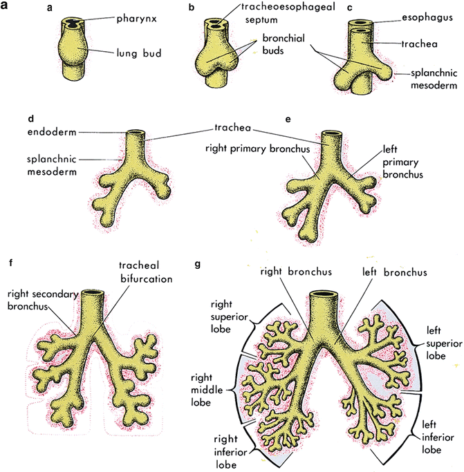 Congenital Malformations of the Trachea | SpringerLink