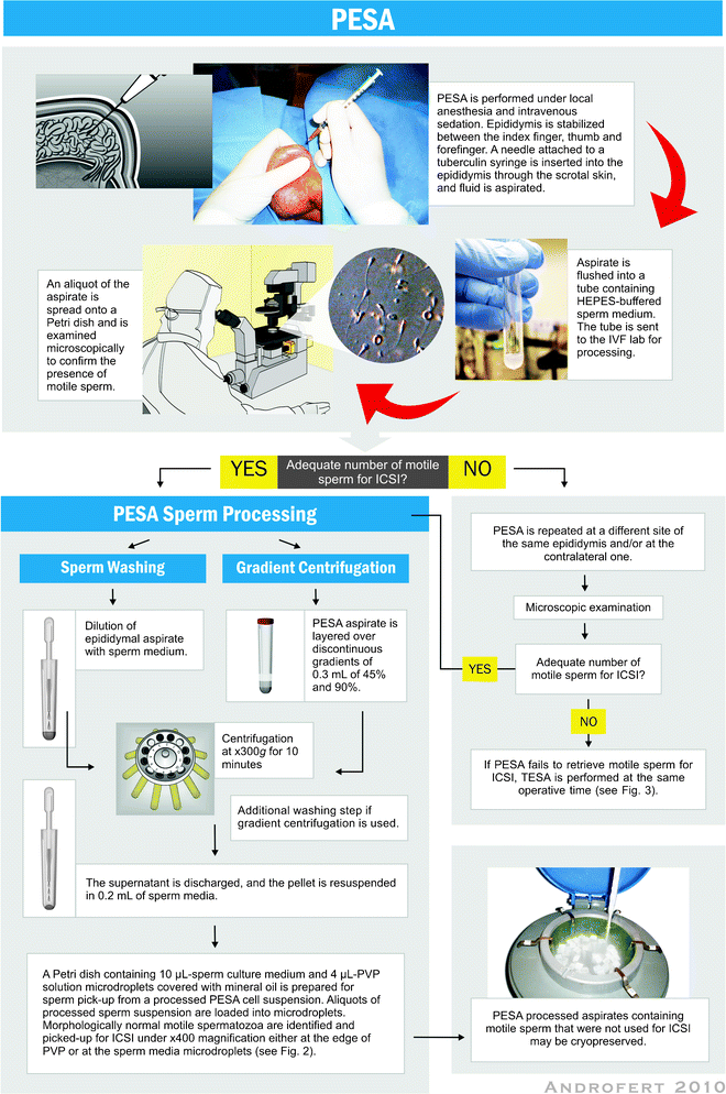 PESA/TESA/TESE Sperm Processing | SpringerLink