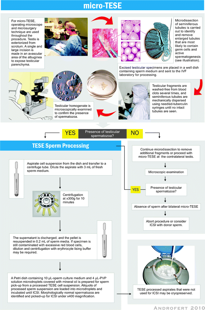 PESA/TESA/TESE Sperm Processing | SpringerLink