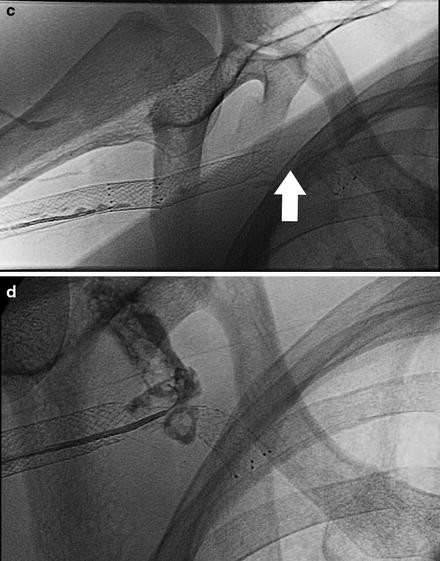 Cephalic Arch Stenosis | SpringerLink