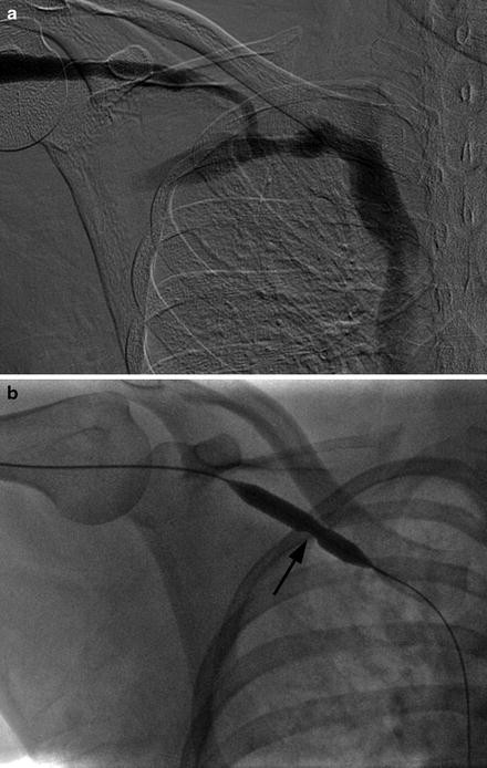 Cephalic Arch Stenosis | SpringerLink