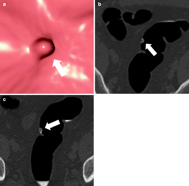 Diminutive Polyps | SpringerLink