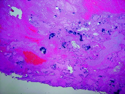 Postpartum Hemorrhage, Subinvolution of the Placental Site, and ...