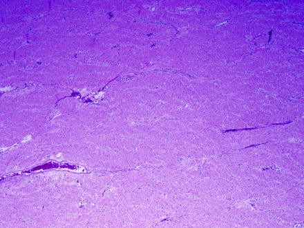 Postpartum Hemorrhage, Subinvolution of the Placental Site, and ...