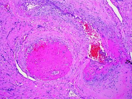 Postpartum Hemorrhage, Subinvolution of the Placental Site, and ...