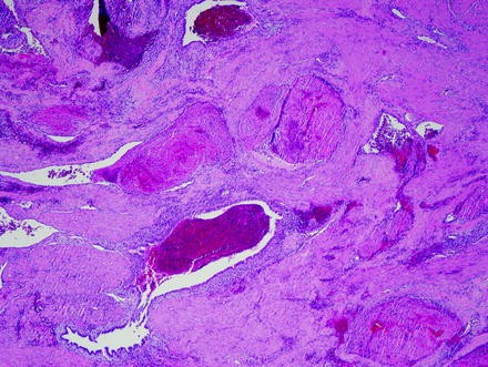 Postpartum Hemorrhage, Subinvolution of the Placental Site, and ...