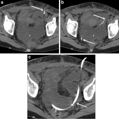 Percutaneous Abscess Drainage | SpringerLink