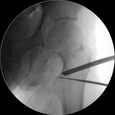 Iliopsoas Tendon Release | SpringerLink
