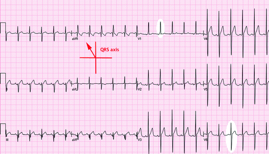 Tetralogy of Fallot | SpringerLink