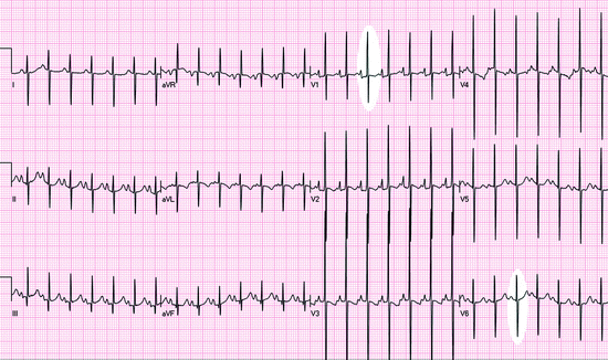 Truncus Arteriosus | SpringerLink