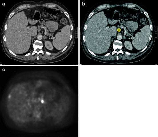 Abdominal Lymph Node Anatomy | SpringerLink