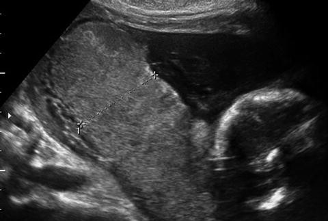 Placental Abruption | SpringerLink