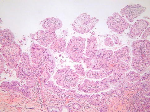 Benign Endocervical Glandular Lesions | SpringerLink