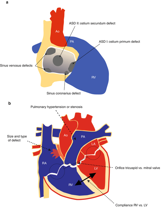 The Right Ventricle in Congenital Heart Diseases | SpringerLink