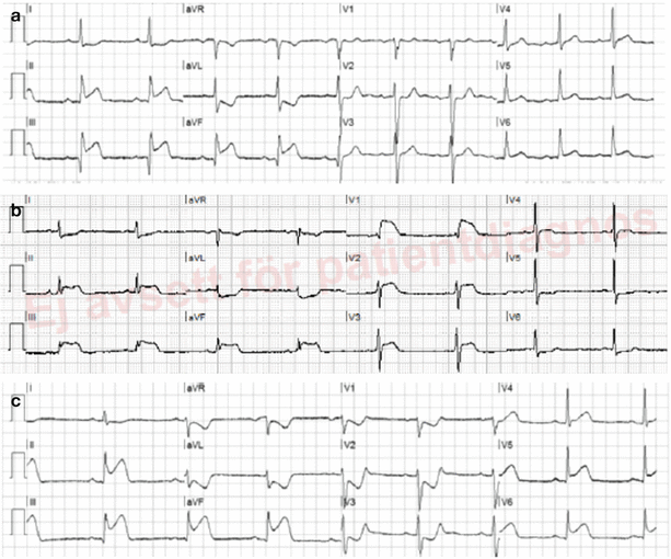 The Electrocardiogram in Coronary Artery Disease | SpringerLink