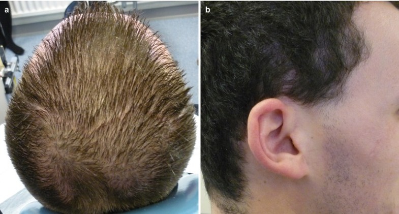 The Coronal Flap | SpringerLink