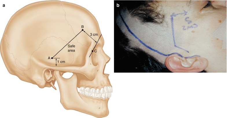The Coronal Flap | SpringerLink