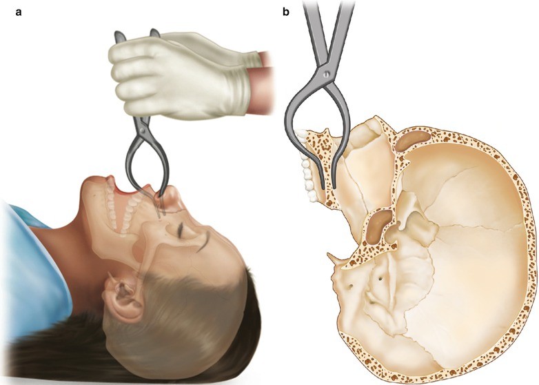 Fractures of the Middle Third of the Facial Skeleton | SpringerLink