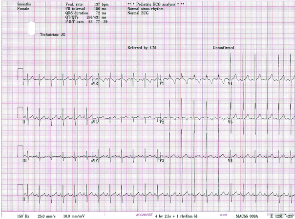 Pacemaker and ICD Implantation in Children | SpringerLink