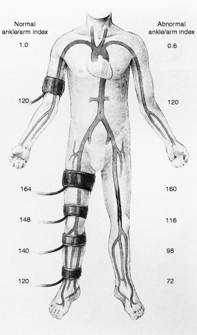 Segmental Doppler Pressures and Doppler Waveform Analysis in Peripheral ...