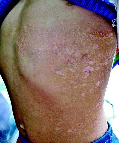 Atrophic Blaschkoid Lines Associated with Syndactyly | SpringerLink