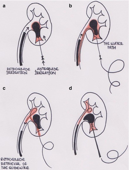 Tips to Enter the Pelvicalyceal System in the Supine Position ...