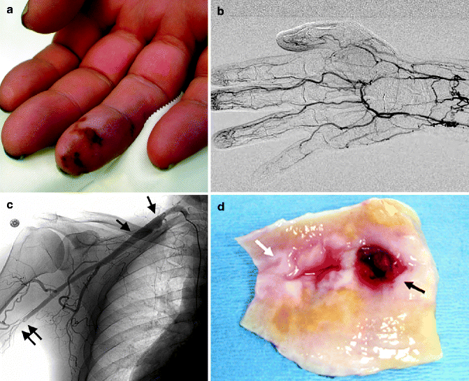 Management of Digital Emboli, Vasospasm, and Ischemia in ATOS ...