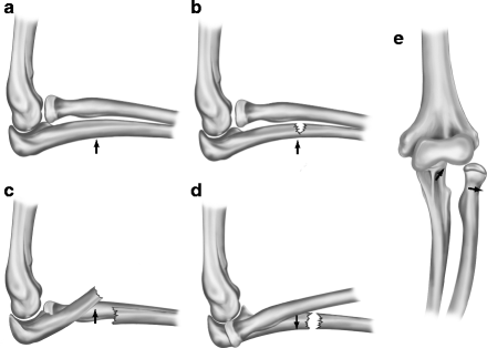 Fractures in Children | SpringerLink