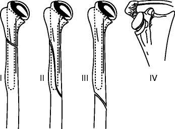 Periprosthetic Fractures | SpringerLink