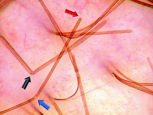 Trichorrhexis Nodosa | SpringerLink